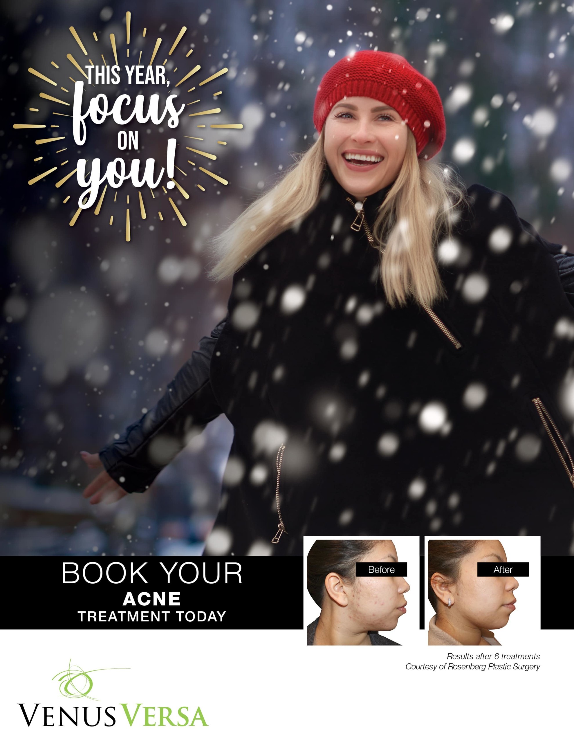 Acne Reduction With Venus Versa – InSkin Med Spa