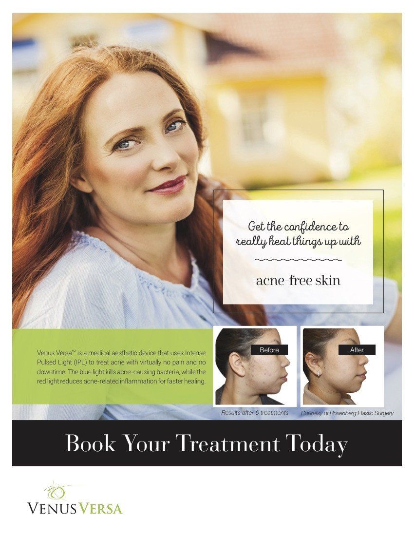 Acne Reduction With Venus Versa – InSkin Med Spa